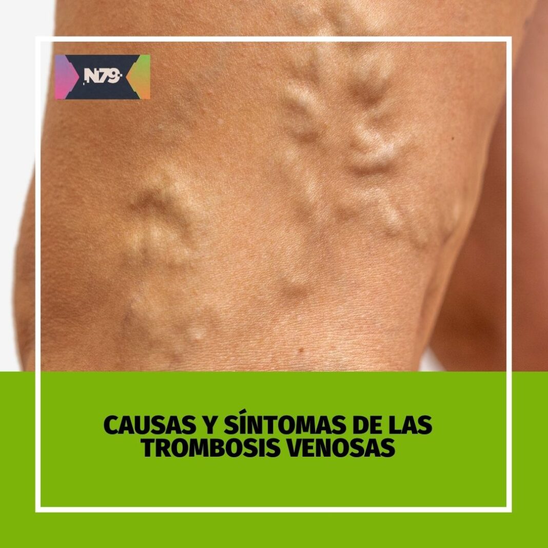 Causas y Síntomas de las trombosis venosas